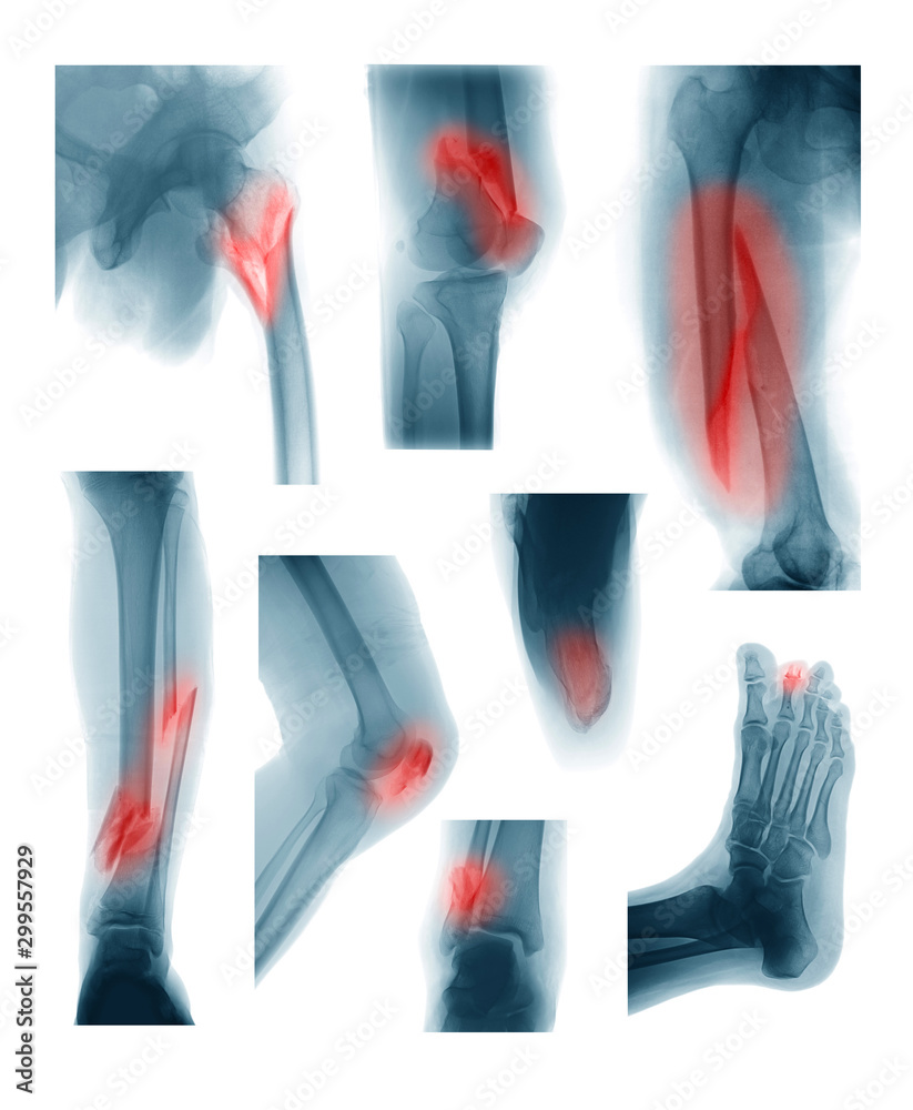 X-ray image showing lower extremity fractures Stock Photo | Adobe Stock