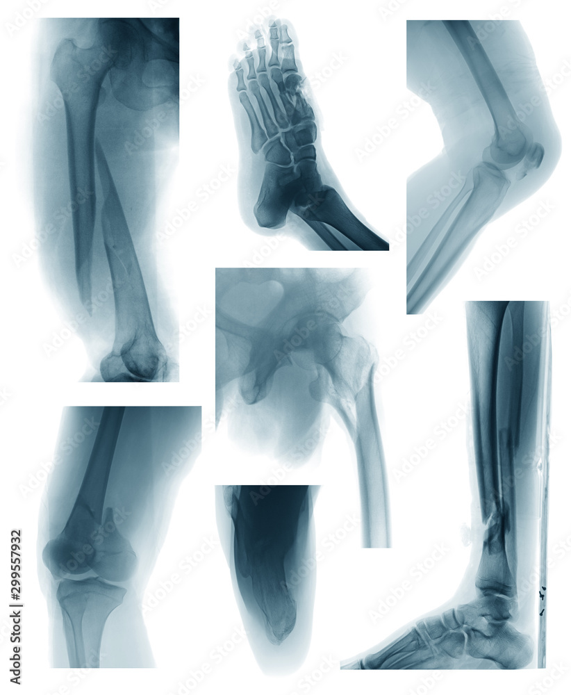 X-ray image showing lower extremity fractures Stock Photo | Adobe Stock