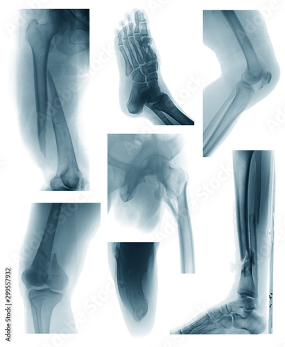 X-ray image showing lower extremity fractures - Buy this stock photo ...