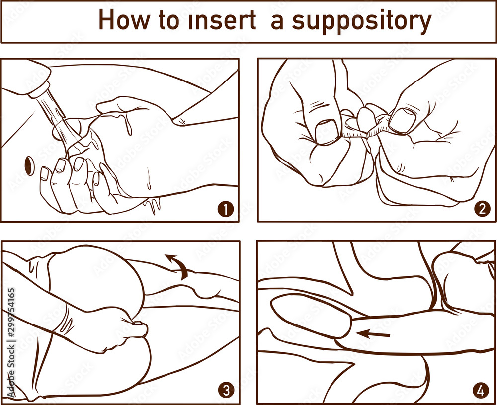 Vektor Drawing to show the location and technique of suppository insertion for the delivery of ...
