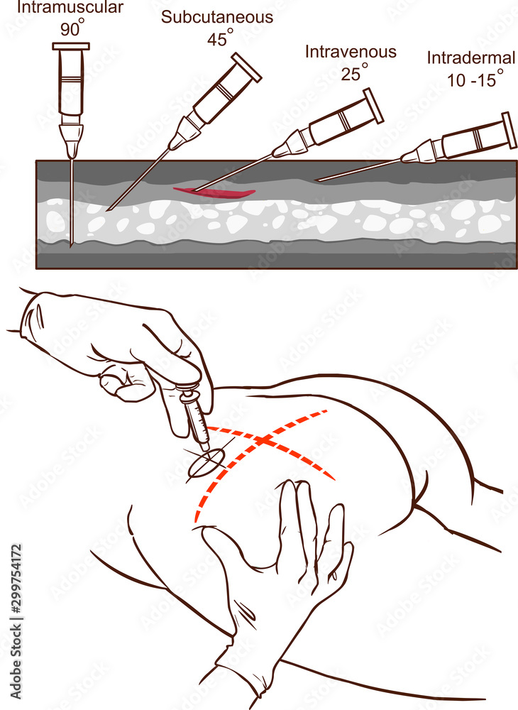 Intramuscular injection vector illustration and Comparison of the ...