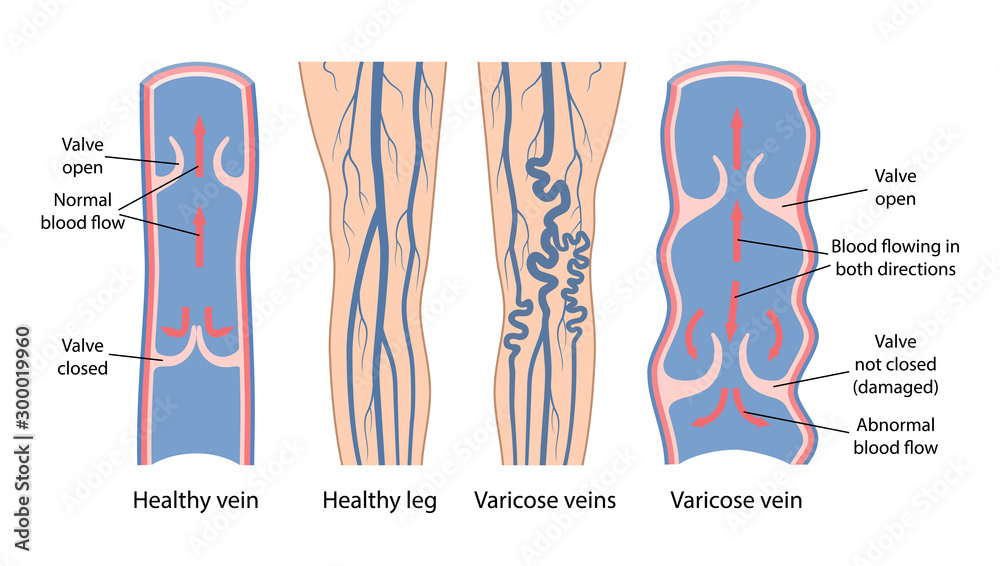 Varicose veins. Image of healthy and diseased legs. A longitudinal ...