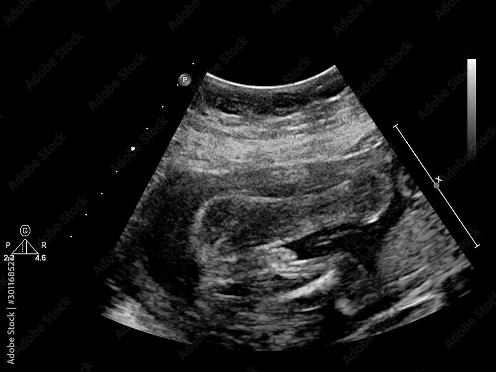 Ultrasound screen with fetal echocardiography. Stock Photo | Adobe Stock
