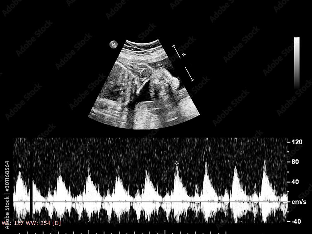 Ultrasound screen with fetal echocardiography. Stock Photo | Adobe Stock