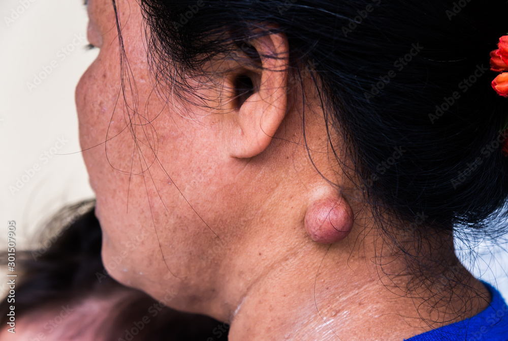 Stock-Foto „Sebaceous cyst on the neck woman form out of sebaceous ...