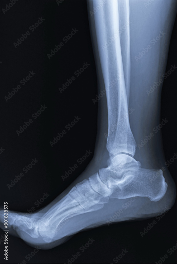 normal radiography of the ankle joint in lateral projection ...