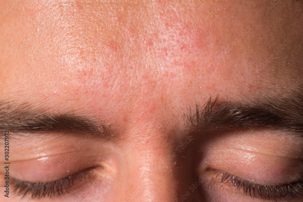 weeping eczema in the stage of exudation. Closeup of forehead area with ...