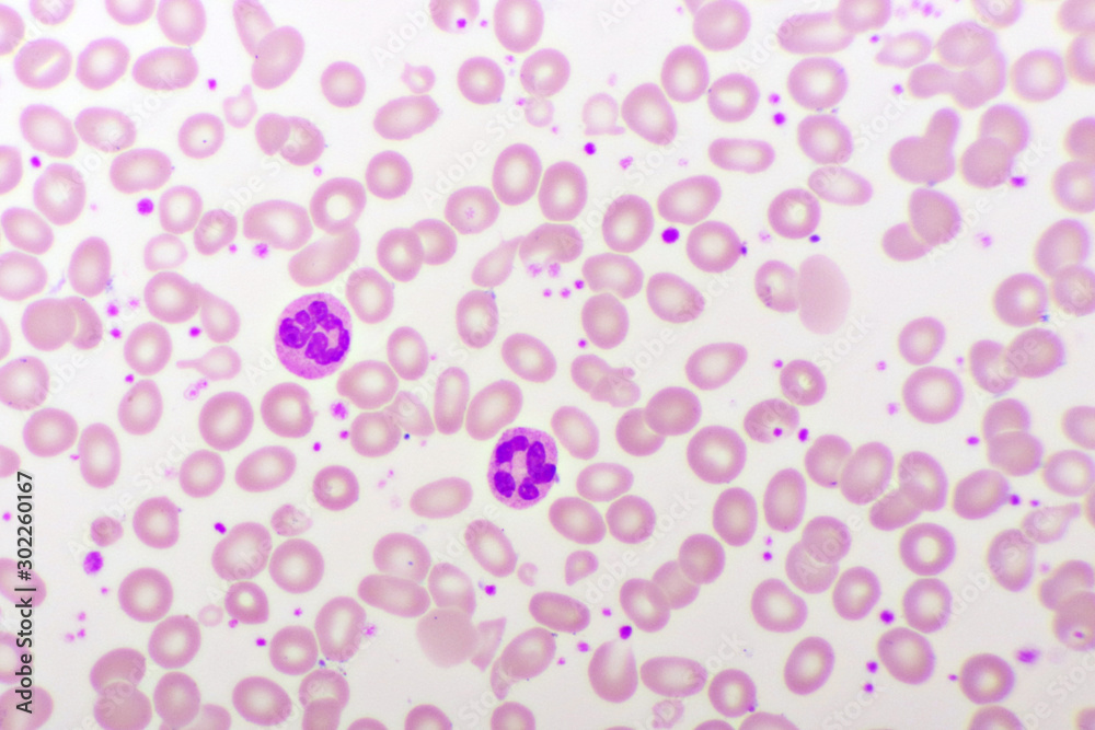 Essential thrombocytosis blood smear, present abnormal high platelet ...