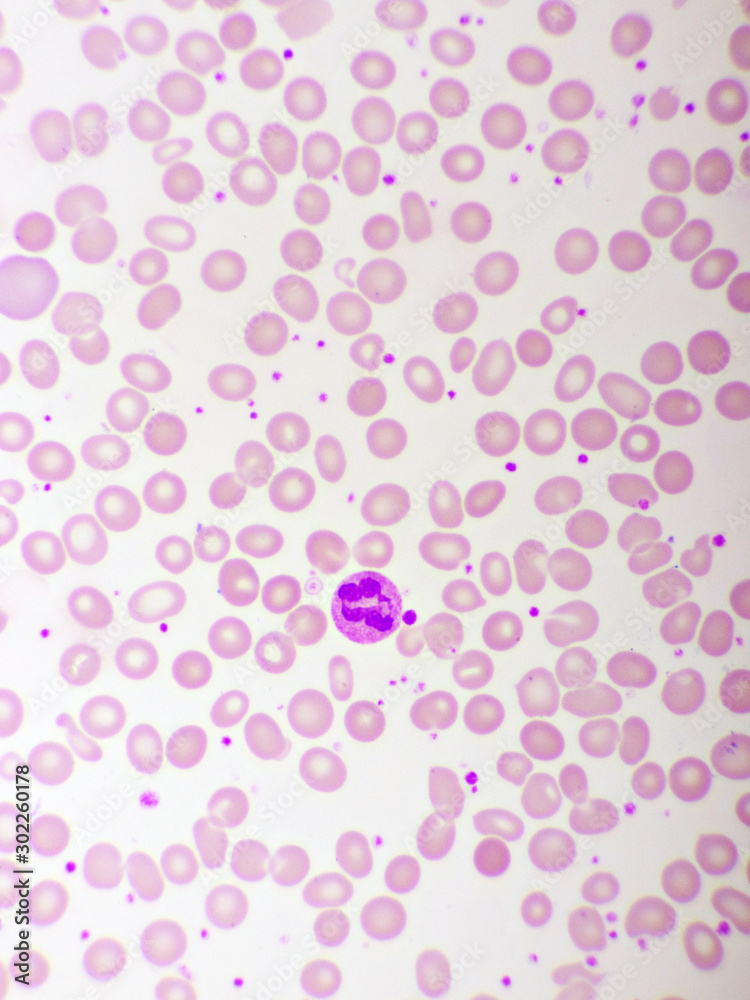 Essential thrombocytosis blood smear, present abnormal high platelet ...