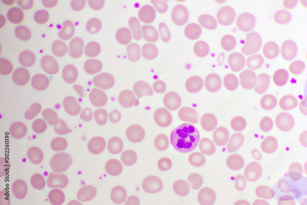 Essential thrombocytosis blood smear, present abnormal high platelet ...