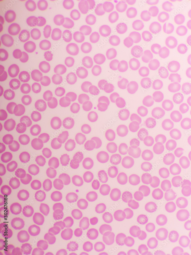Red blood cells in blood smear, Wright-Giemsa stain, analyze by ...