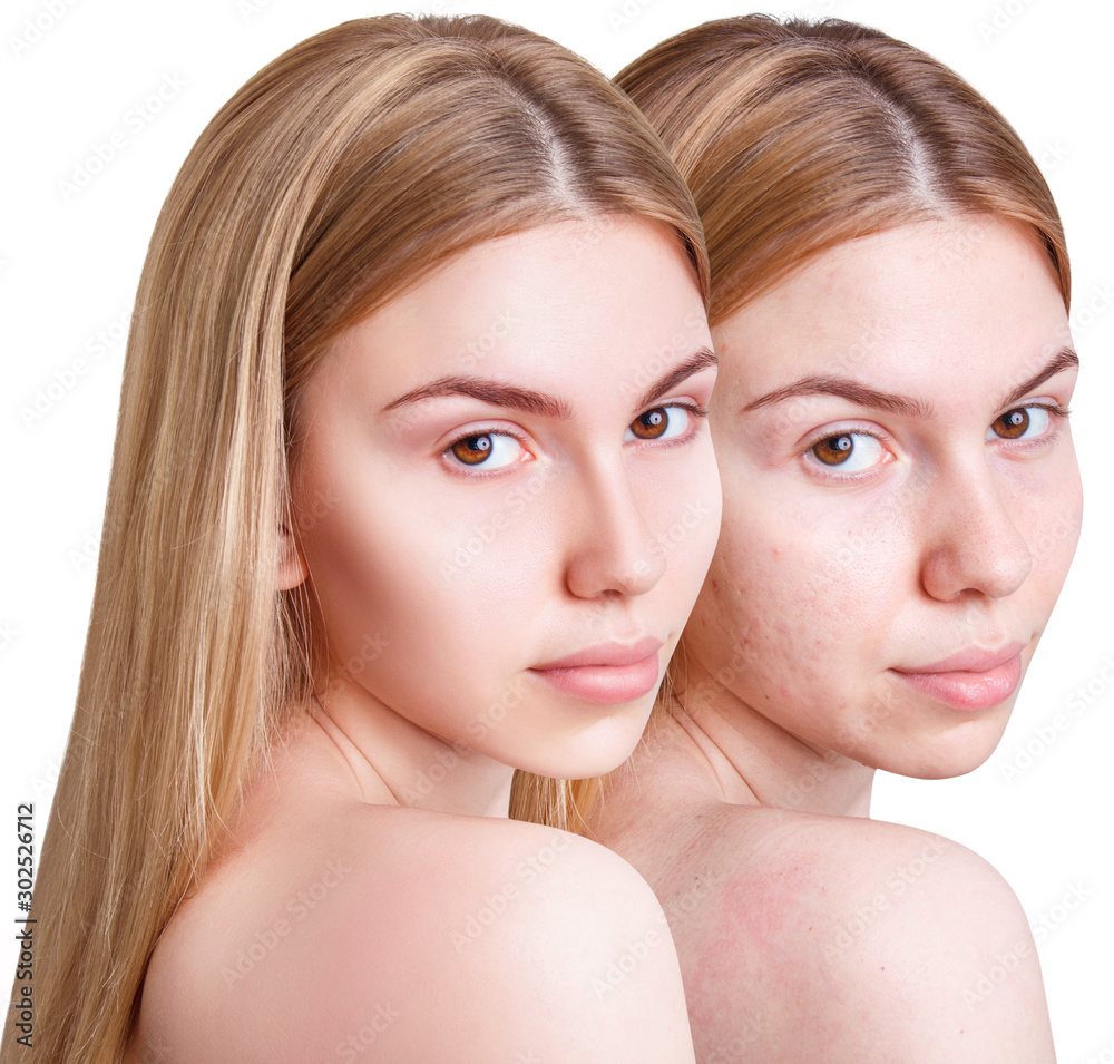Face of beautiful woman before and after skin treatment or retouch ...