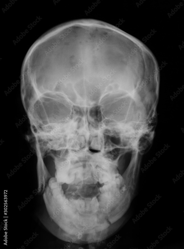 X-ray image of skull, anteroposterior (AP) view, showing mandibura ...