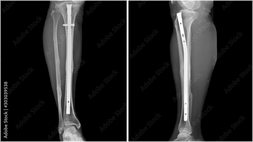 ภาพถ่าย Stock Film leg X-ray radiograph showing leg bone broken (tibia ...