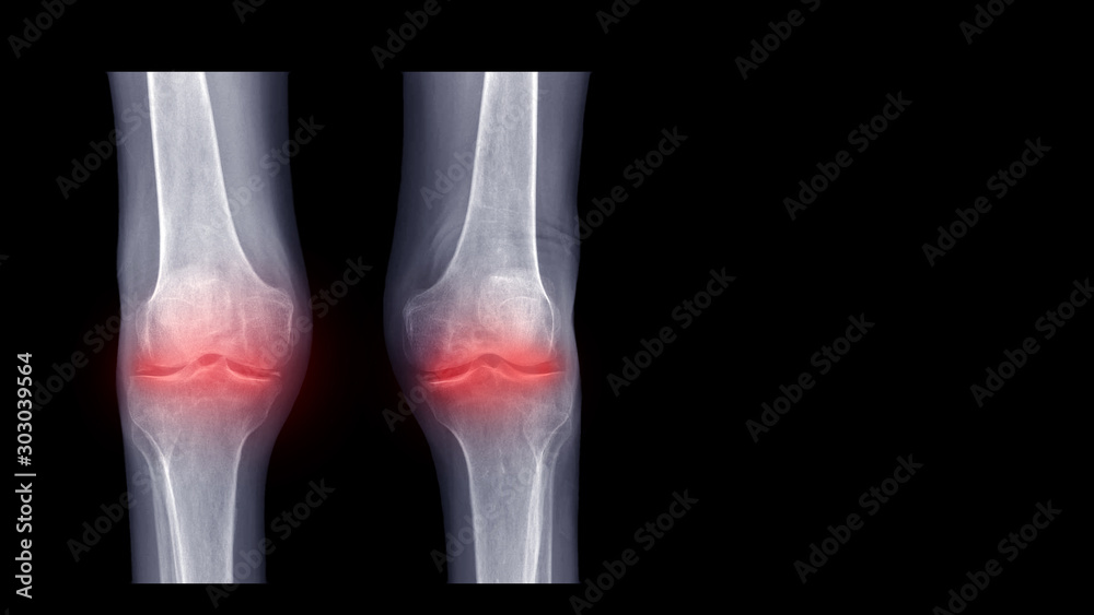 Film X ray knee radiograph show calcified meniscus from Pseudogout ...