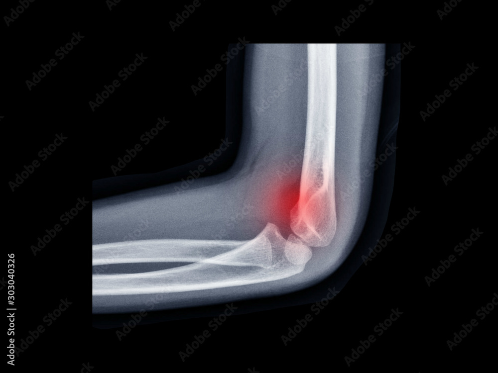 Film X-ray elbow radiograph show elbow bone broken (supracondylar of ...