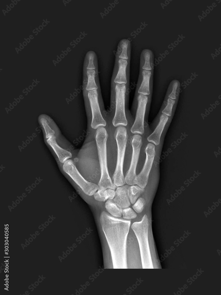 ภาพถ่าย Stock Film x-ray hand radiograph show normal human anatomy of ...