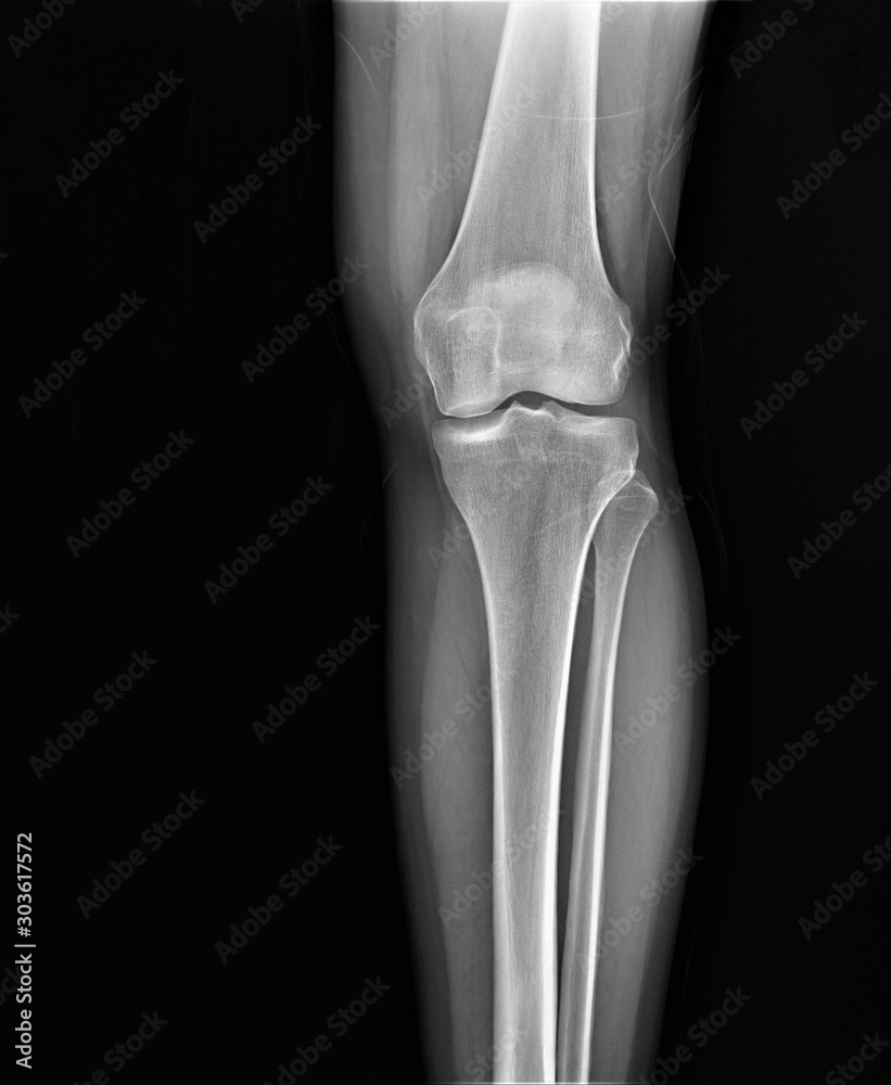 normal radiography of the knee joint in lateral projection, medical ...