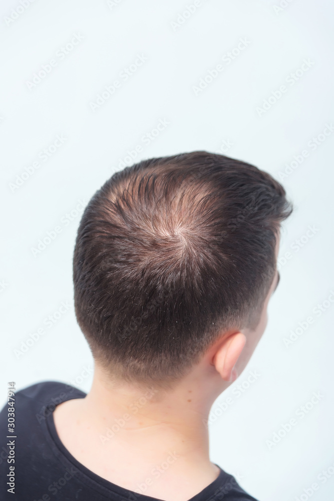 Early male pattern baldness. Hair loss in a young man. Beginning bald ...
