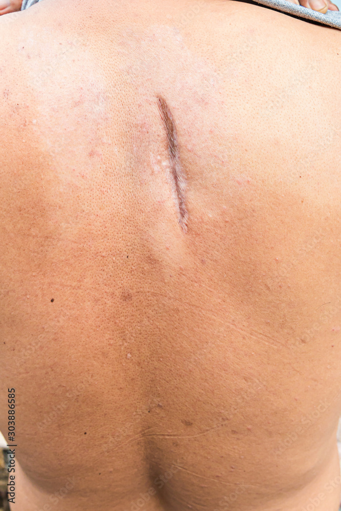 Raised scar. scar after appendectomy. cyanotic keloid scar caused by ...