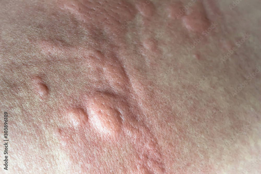 urticaria on skin. rashes, of which urticaria and toxic erythema are ...