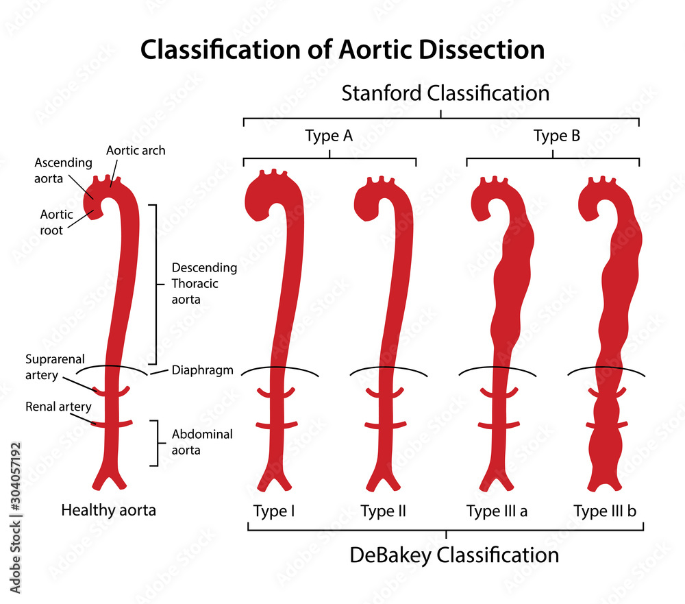 Classification of aortic dissection: Stanford, DeBakey. Healthy aorta ...