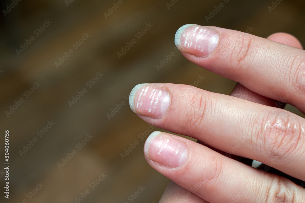 vitamin deficiency avitaminosis anemia nail problem with white dots ...