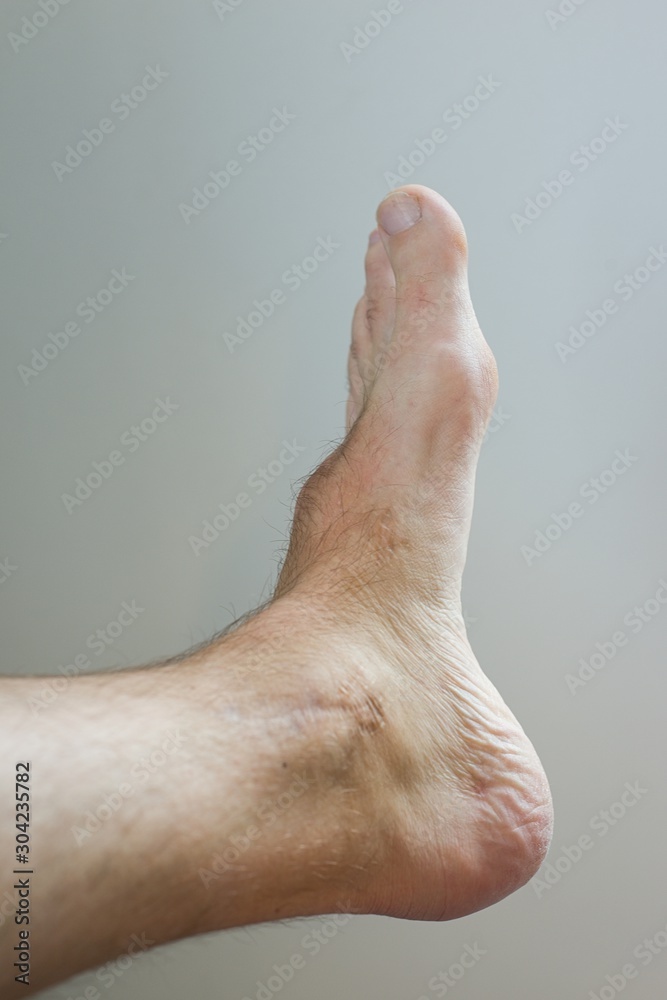 Left foot following high energy impact and rotation, Lisfranc joint ...