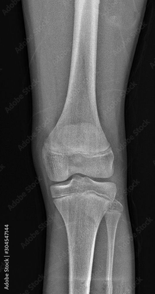 normal radiography of the knee joint in lateral projection, medical ...