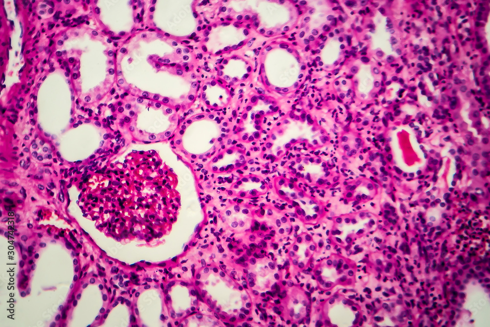 Chronic pyelonephritis, light micrograph, photo under microscope Stock ...