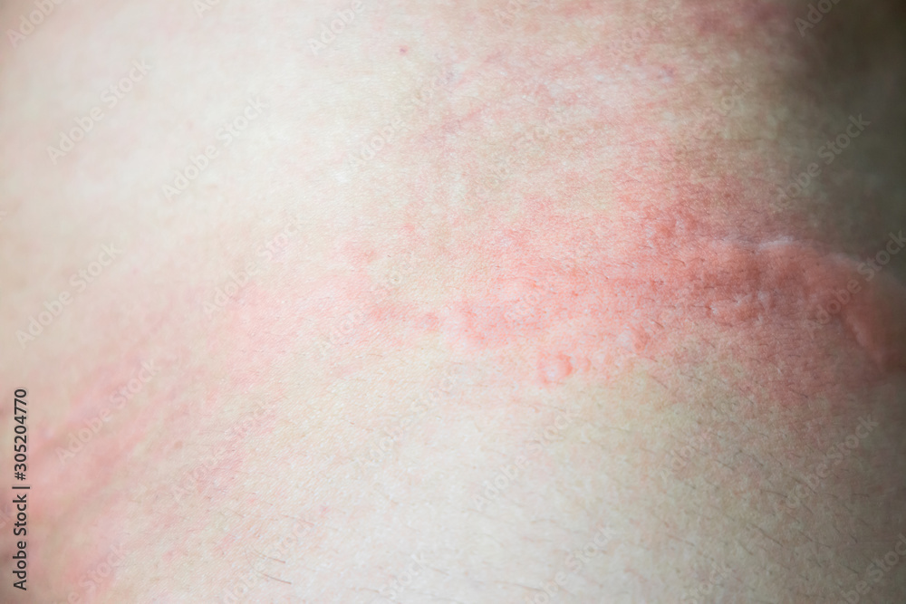 urticaria on skin. rashes, of which urticaria and toxic erythema are ...