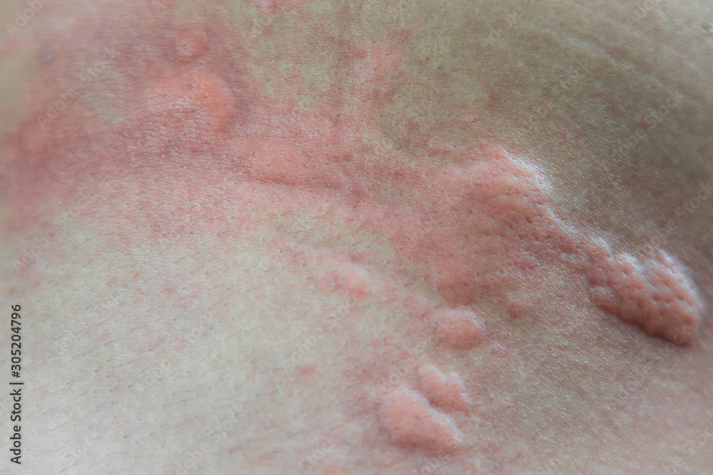 Foto de Stock urticaria on skin. rashes, of which urticaria and toxic ...