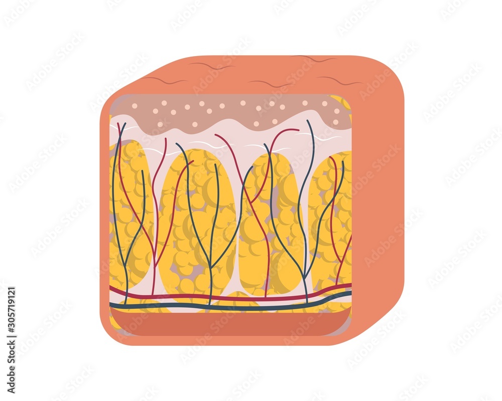 Cellulite formation vector illustration diagram, medical information ...
