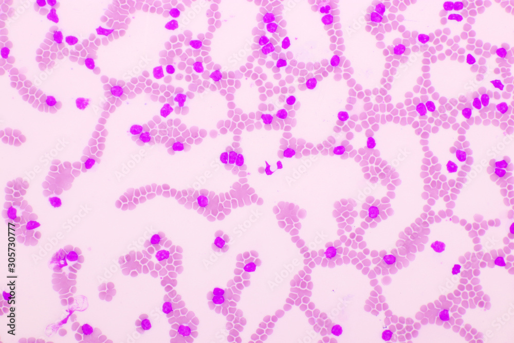 Picture of acute lymphocytic leukemia or ALL cells in blood smear ...
