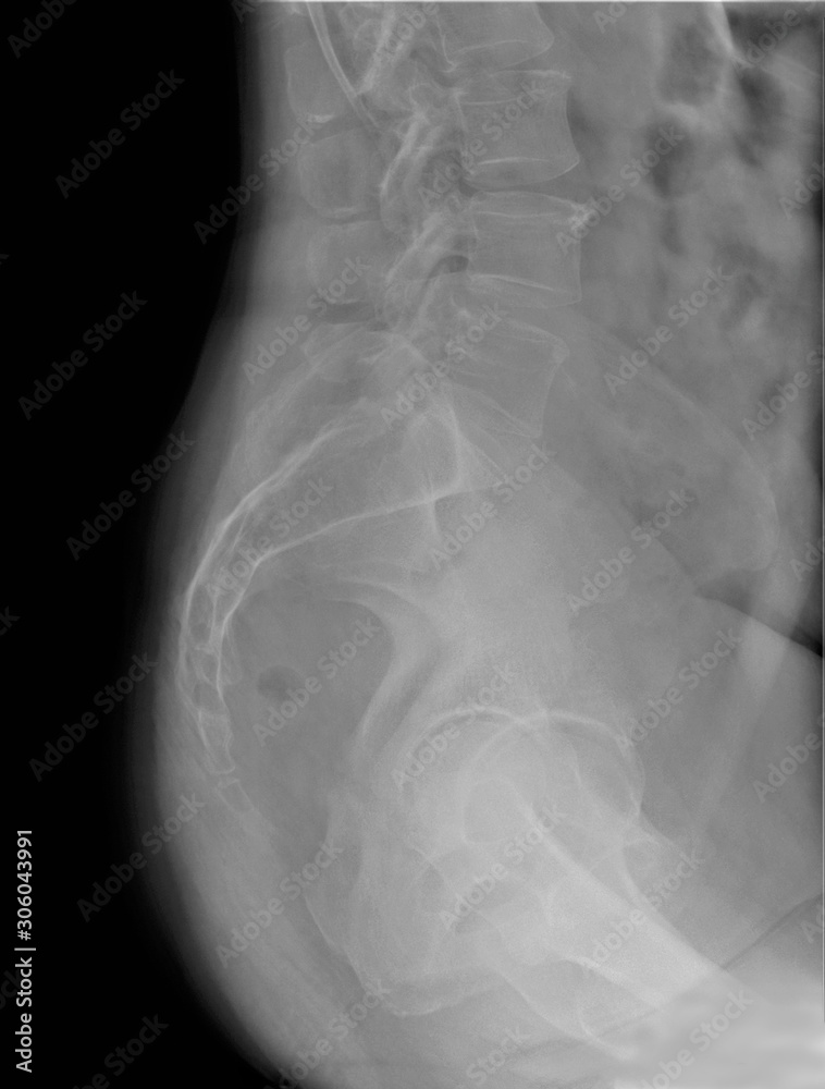 radiography of lumbar spine, sacrum, medical diagnosis Stock Photo ...