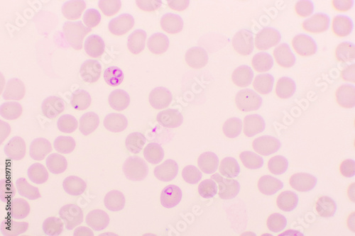 Malaria parasite in red blood cells, ring form stage of Plasmodium ...