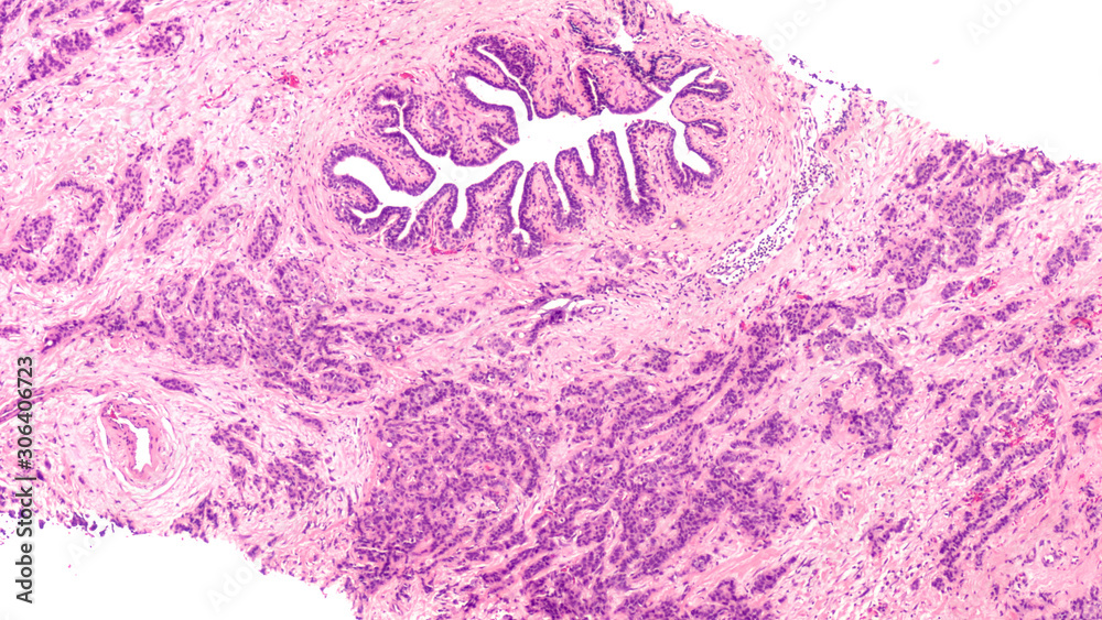 Low power photomicrograph of a breast core biopsy showing an invasive ... Low power photomicrograph of a breast core biopsy showing an invasive ...