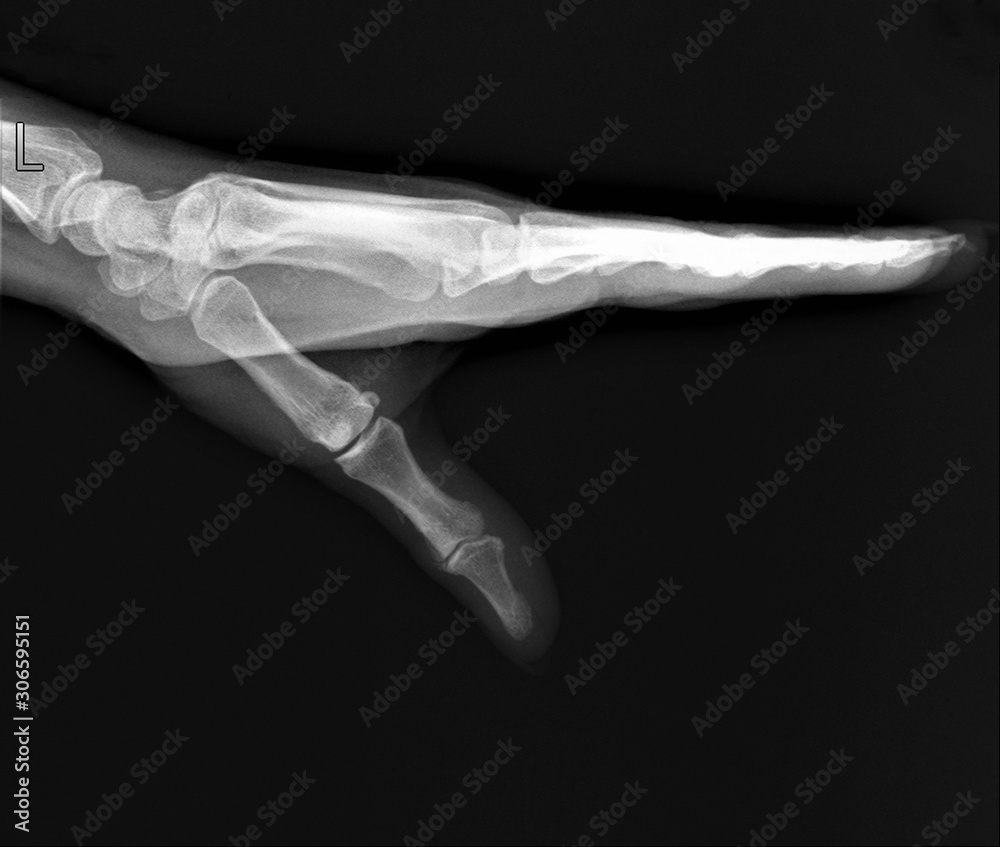 Foto de Stock normal x-ray of the hand bones and fingers,orthopedics ...