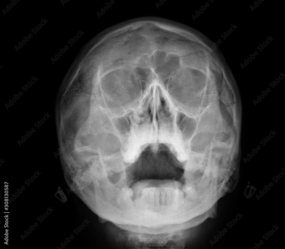 radiography of the paranasal sinuses of the skull, medical diagnosis ...
