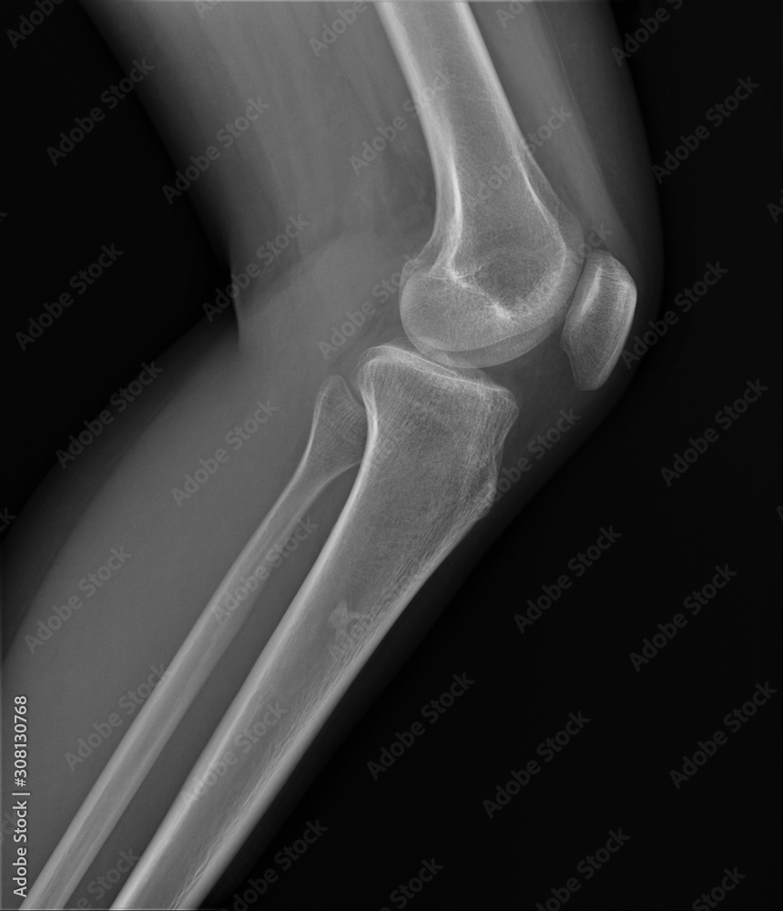 normal radiography of the knee joint in lateral projection, medical ...