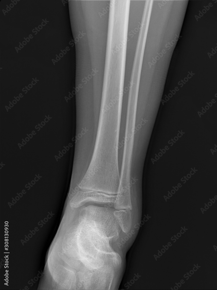 normal radiograph of the ankle joint in front projection,osteoarthritis ...