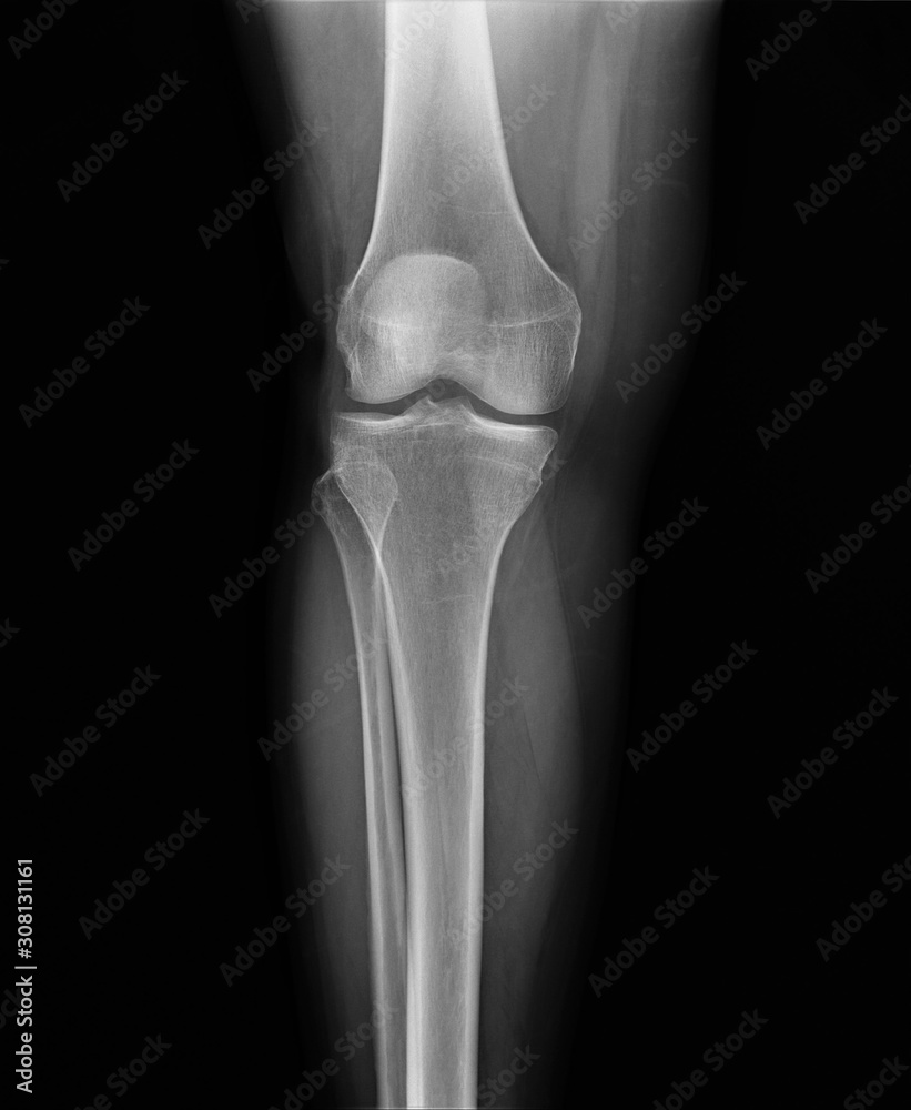normal radiography of the knee joint in the frontal projection medical ...