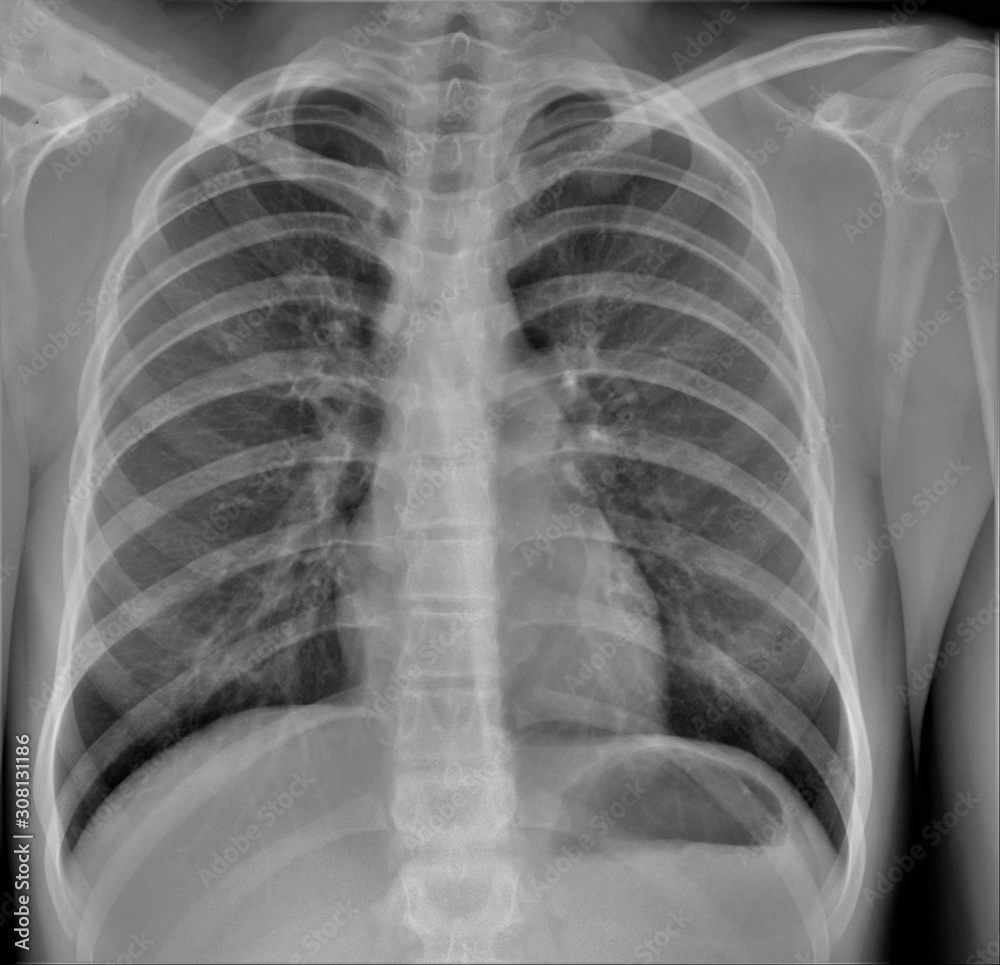 normal radiography of chest organs in direct projection, pulmonology ...
