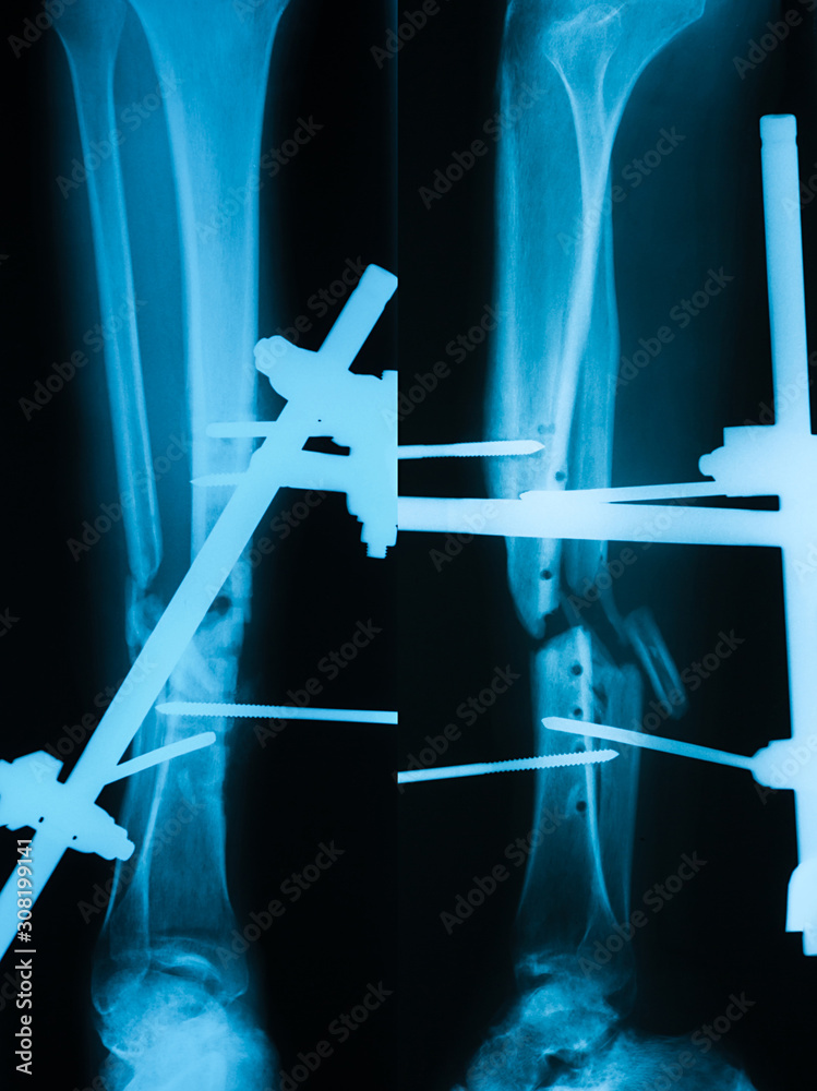 Foto de Stock X-ray image of broken leg with external fixation, after ...