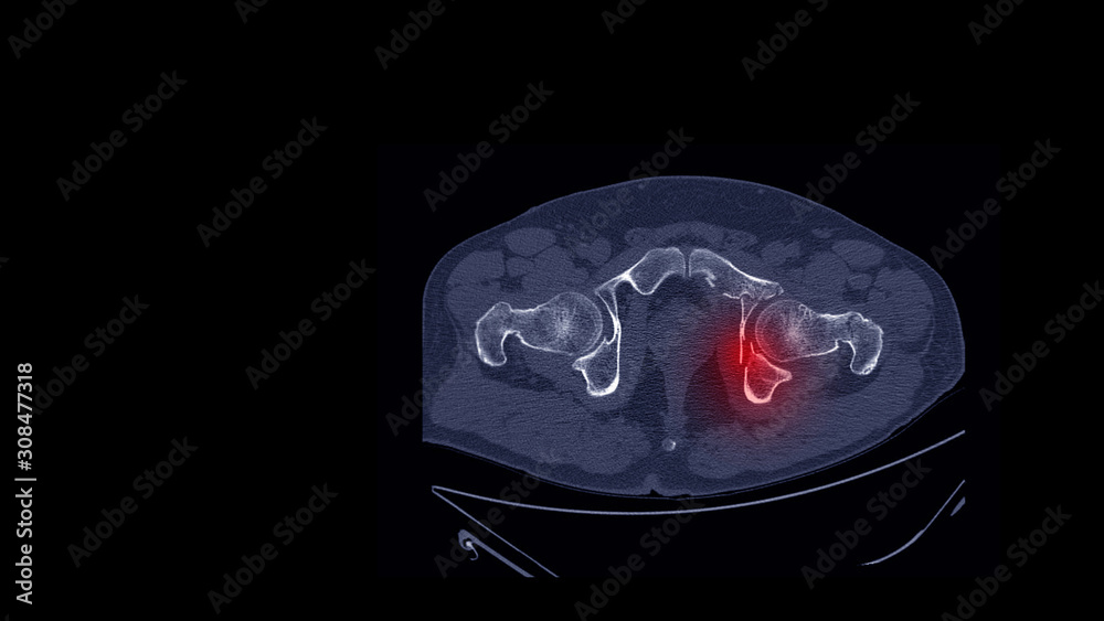 CT scan(computed tomography)hip radiography show broken hip bone or ...