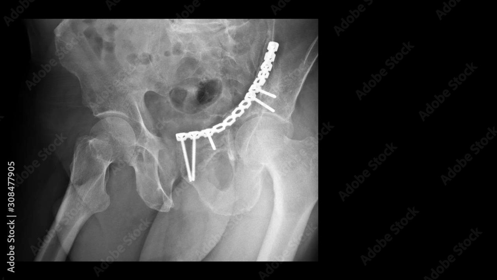 Film X ray hip radiograph show broken hip bone or acetabular fracture ...