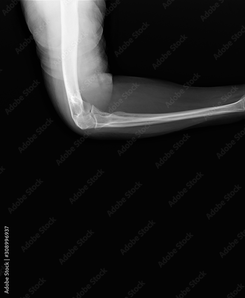 x-ray of the normal elbow joint. traumatology and orthopedics, medical ...
