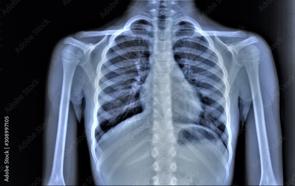 chest x-ray, pneumonia, emphysema, pulmonology, diagnosis of diseases ...