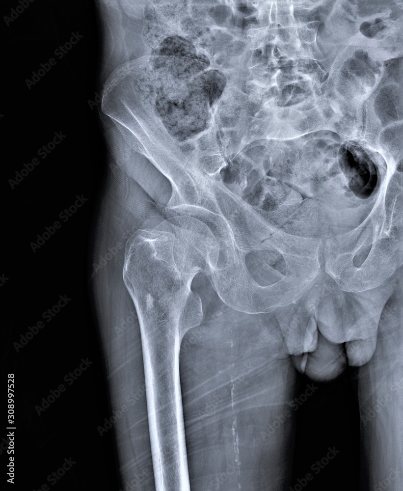 x-ray of hip joint with femoral neck fracture, traumatology and ...