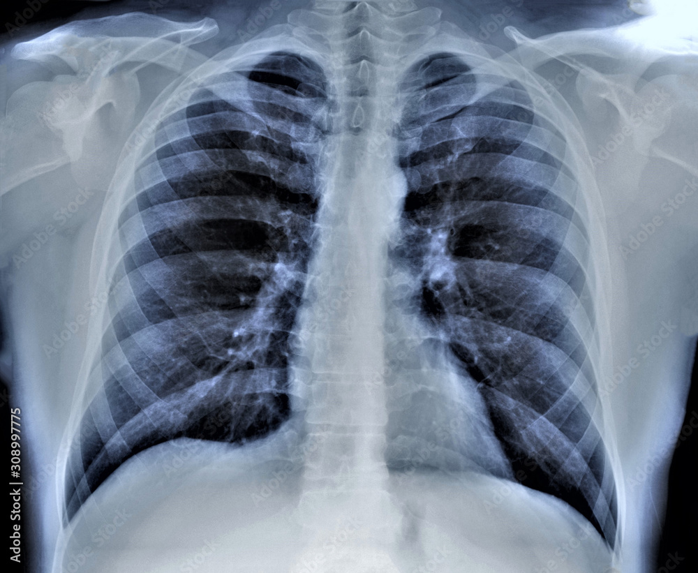 chest x-ray, pneumonia, emphysema, pulmonology, diagnosis of diseases ...